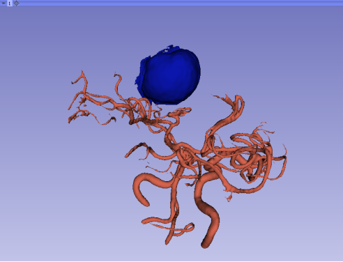 3Dslicer联合手机sina软件应用左侧额叶脑膜瘤切除 - 脑医汇