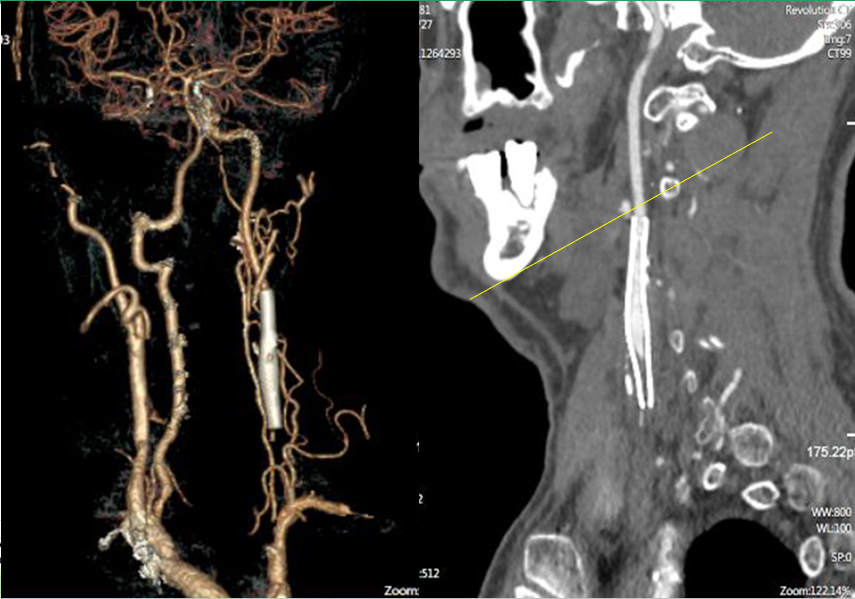 左侧CAS术后支架内再狭窄致CCA闭塞复合手术再通一例 - 脑医汇