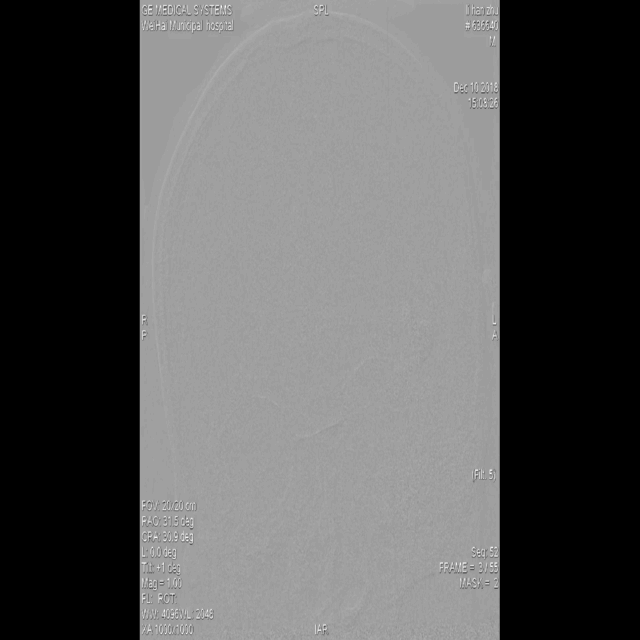 左侧CAS术后支架内再狭窄致CCA闭塞复合手术再通一例 - 脑医汇
