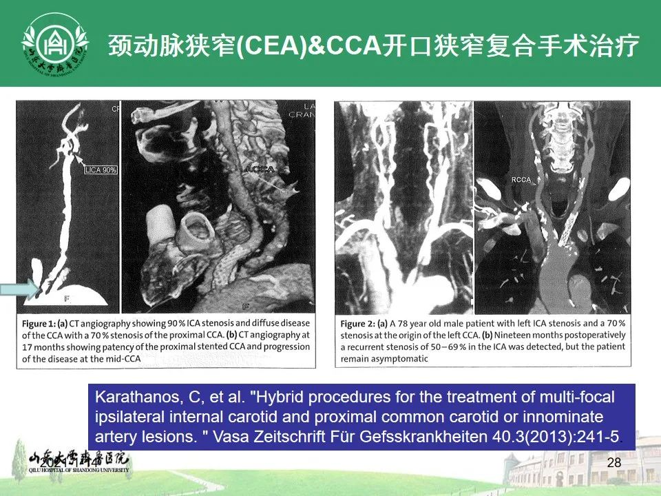 左侧CAS术后支架内再狭窄致CCA闭塞复合手术再通一例 - 脑医汇