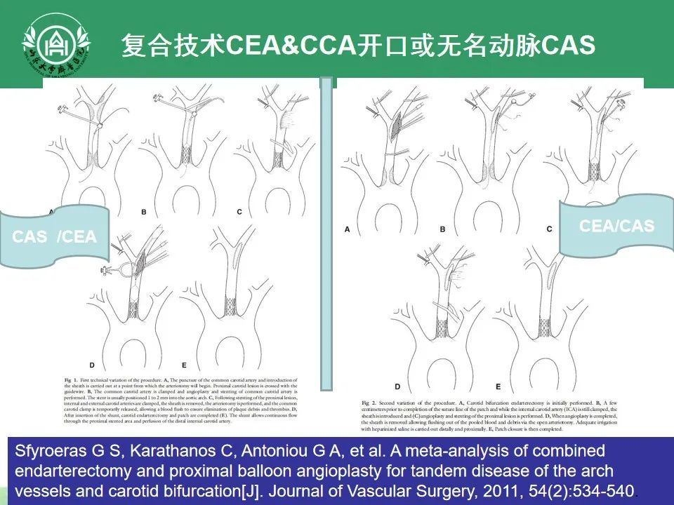 左侧CAS术后支架内再狭窄致CCA闭塞复合手术再通一例 - 脑医汇