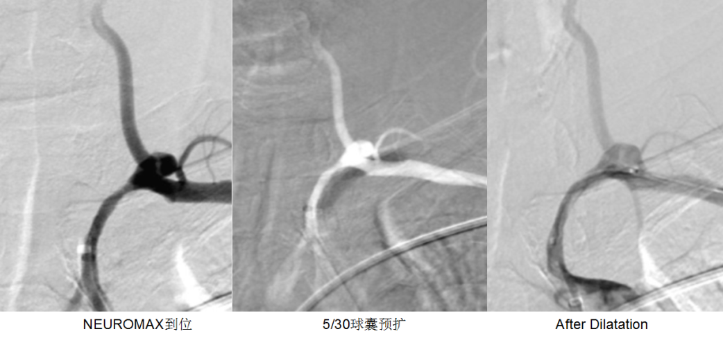 不辱使命 | 通过Neuron Max定位球囊支架治疗狭窄一例 - 脑医汇