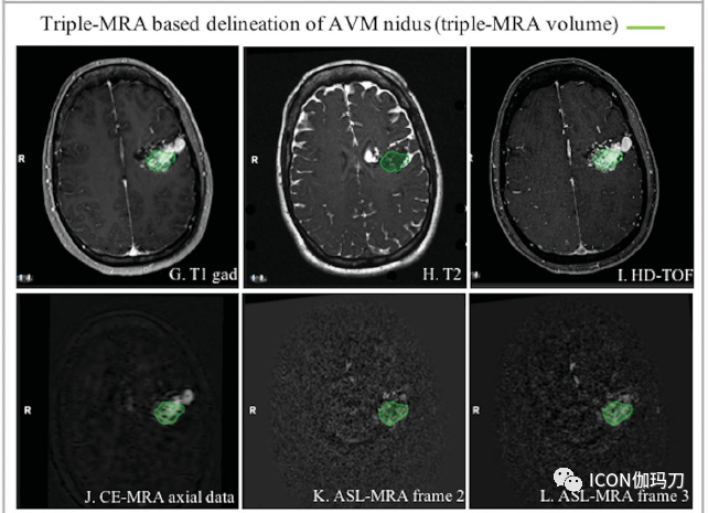 【文献快递】应用三重磁共振血管造影成像(triple- MRA)进行伽玛刀放射外科治疗脑动静脉畸形的剂量计划 - 脑医汇