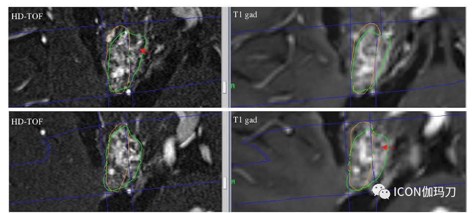 【文献快递】应用三重磁共振血管造影成像(triple- MRA)进行伽玛刀放射外科治疗脑动静脉畸形的剂量计划 - 脑医汇