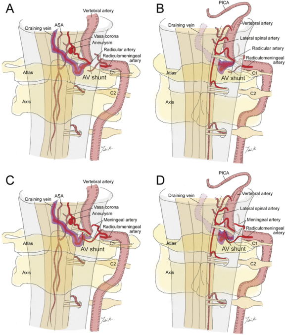 庚云|枕下后正中入路左侧寰枕交界区硬脊膜动静脉瘘切除术 - 脑医汇 - 神外资讯 - 神介资讯