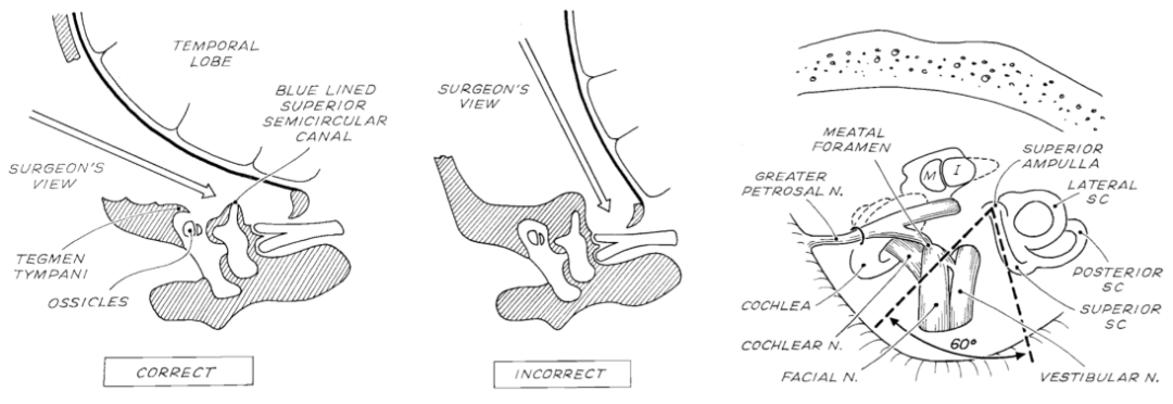 Ugo Fisch教授侧颅底3D解剖课程 | 第6-7集 本季终！ - 脑医汇