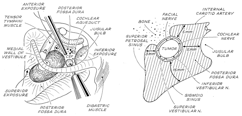 Ugo Fisch教授侧颅底3D解剖课程 | 第6-7集 本季终！ - 脑医汇