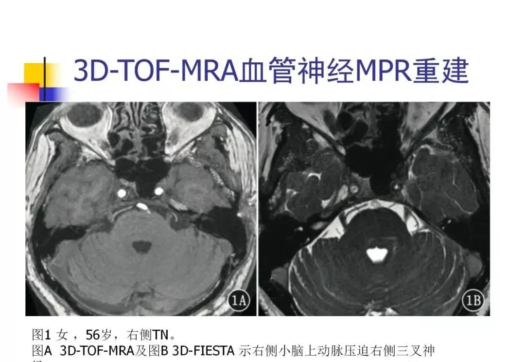 3D-TOF-MRA在三叉神经面肌抽搐综合征中的应用 - 脑医汇
