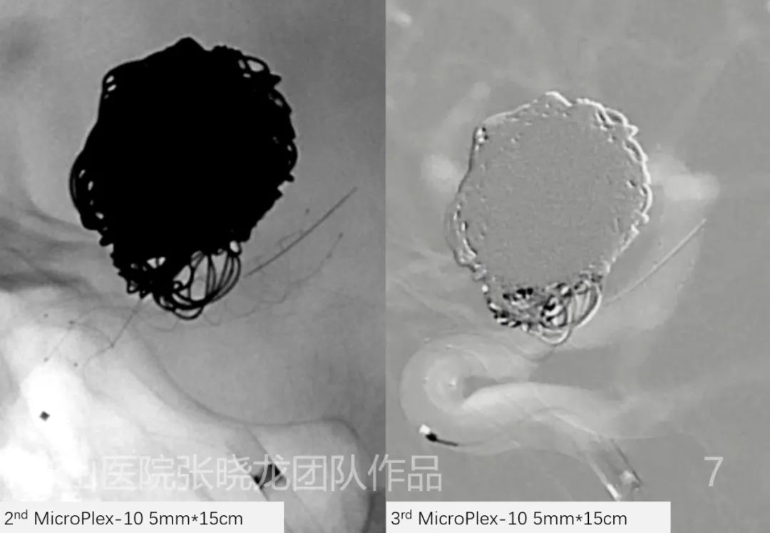 Stent Assisted Coiling of a Recurrence Ophthalmic Aneurysm - 脑医汇