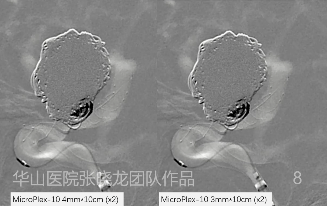 Stent Assisted Coiling of a Recurrence Ophthalmic Aneurysm - 脑医汇