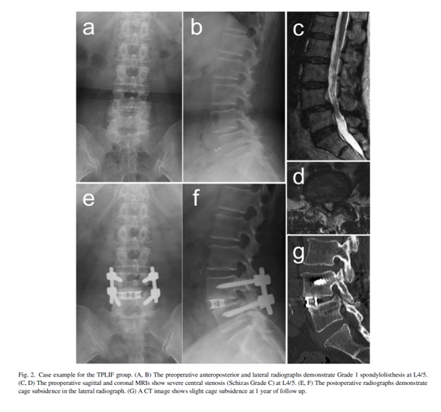 重度退行性腰椎管狭窄症治疗的术式比较： 间接减压的OLIF vs 直接减压的TLIF/PLIF - 脑医汇