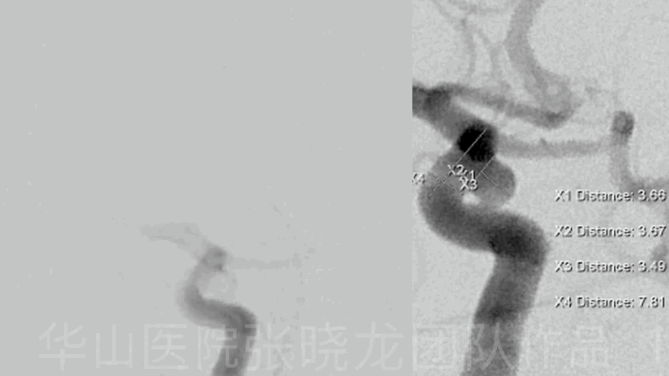 Stent Assisted Coiling Of An Ophthalmic Aneurysm - 脑医汇