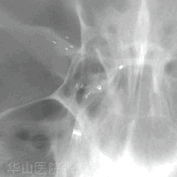 Stent Assisted Coiling Of An Ophthalmic Aneurysm - 脑医汇