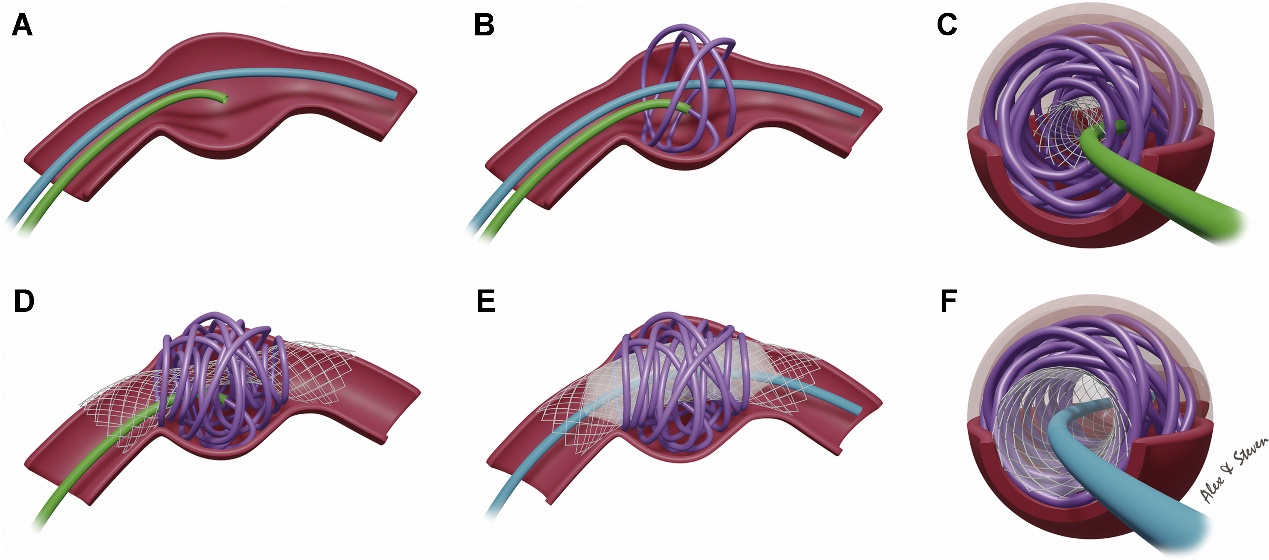 改良Balloon-in-Stent技术治疗椎动脉夹层动脉瘤 - 脑医汇