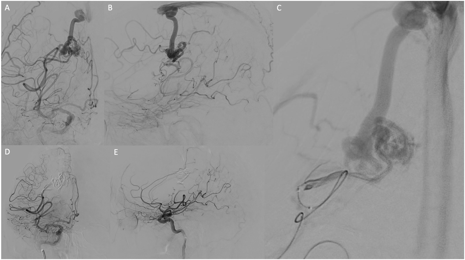 双腔球囊和单纯微导管在Onyx栓塞DAVFs和AVMs中的比较 - 脑医汇