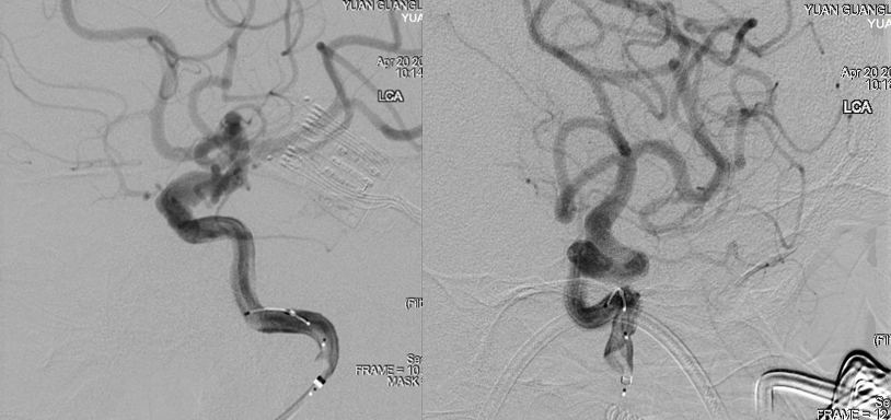 国产新型密网支架治疗颈—眼宽颈动脉瘤 - 脑医汇