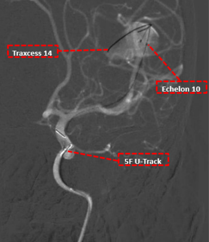 「“术”说卒中」第6期丨U-Track®支撑导管应用病例分享——黄清海教授 - 脑医汇