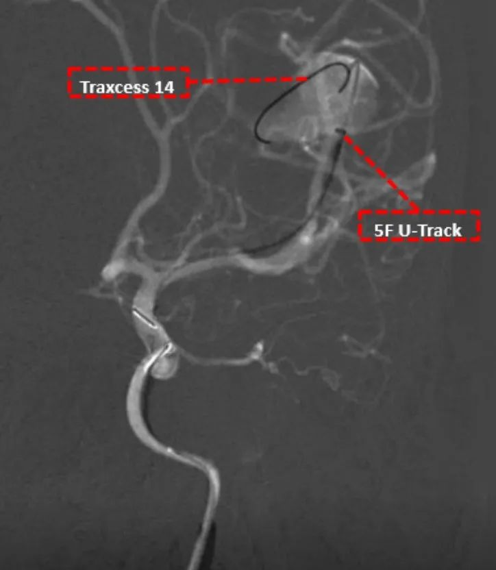 「“术”说卒中」第6期丨U-Track®支撑导管应用病例分享——黄清海教授 - 脑医汇