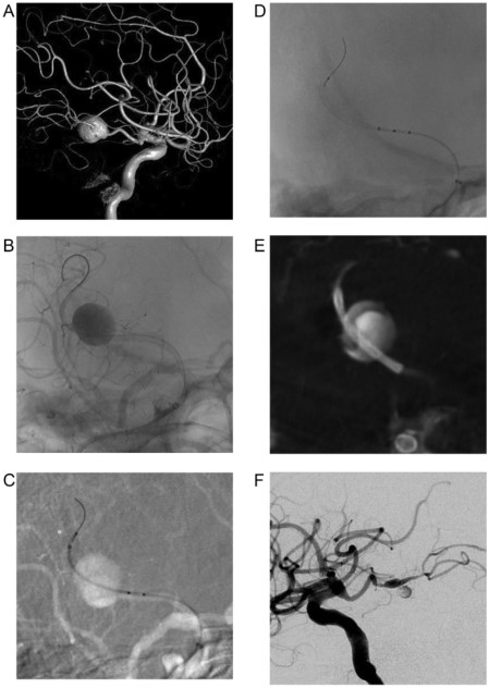 使用新型血流导向装置Surpass Evolve治疗颅内动脉瘤：安全性结果和6个月的影像学随访 - 脑医汇