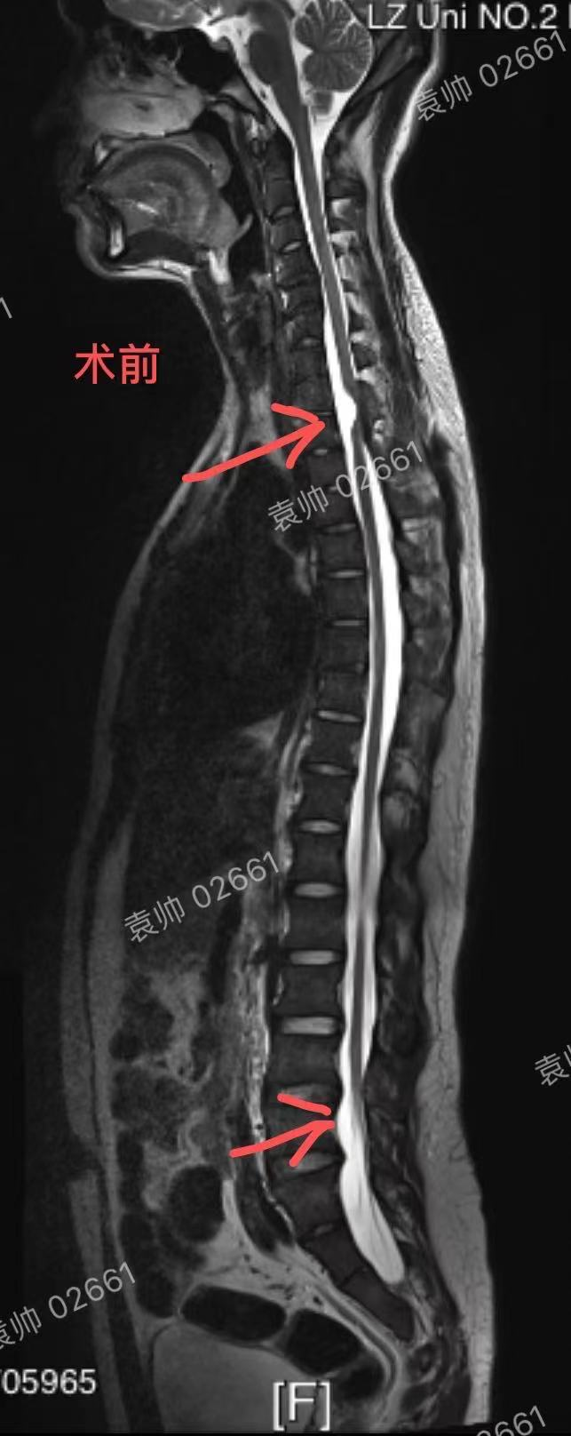 C7-T2脊髓腹侧囊性占位病变一例 - 脑医汇