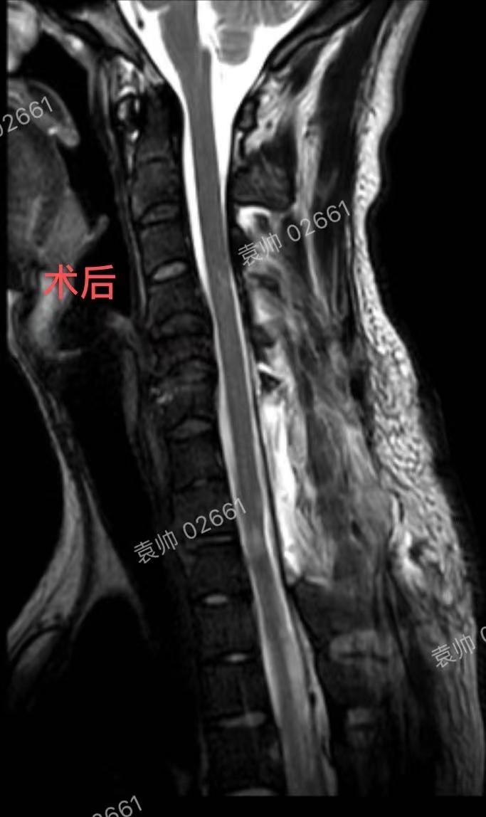 C7-T2脊髓腹侧囊性占位病变一例 - 脑医汇