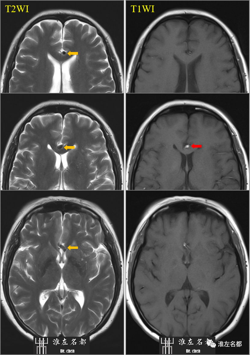 神经血管影像速阅(66)：单侧大脑前动脉延长扩张 - 脑医汇