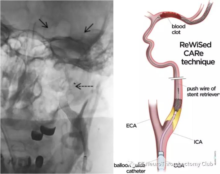 马尾巴的功能：取栓支架导丝能做什么？ - 脑医汇