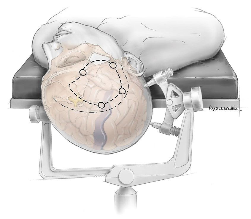 经典翼点入路解析 - 脑医汇 - 神外资讯 - 神介资讯