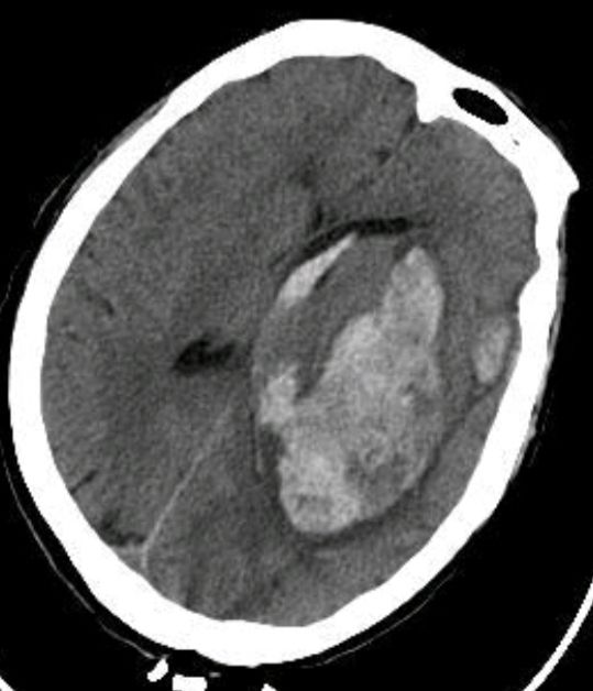 神经内镜下脑出血治疗 - 脑医汇